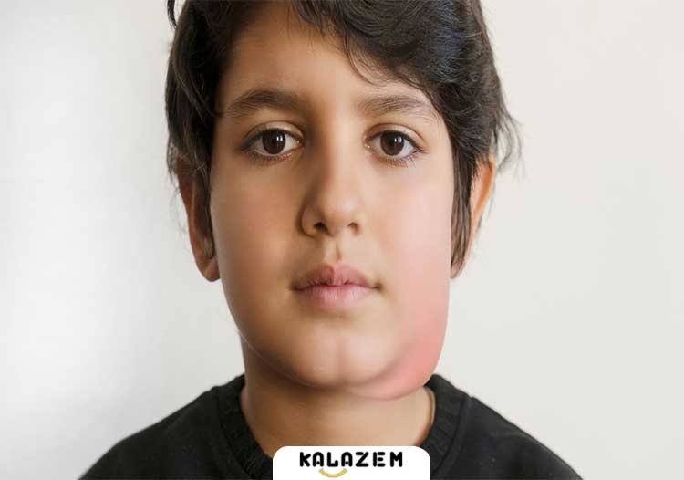 بیماری اوریون از چه راه هایی ایجاد می شود و چه علائم و نشانه هایی دارد ...